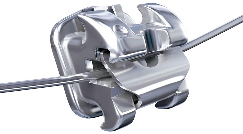 Hoe werkt een slotjesbeugel? - Blog - Ortho Fleur